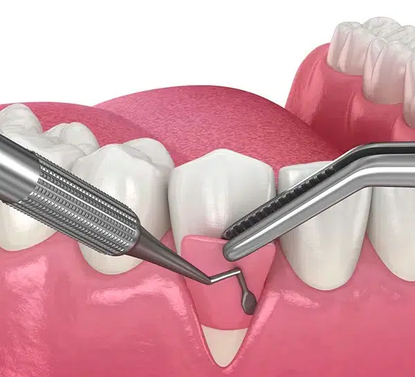 Flap Surgery Cosmodent